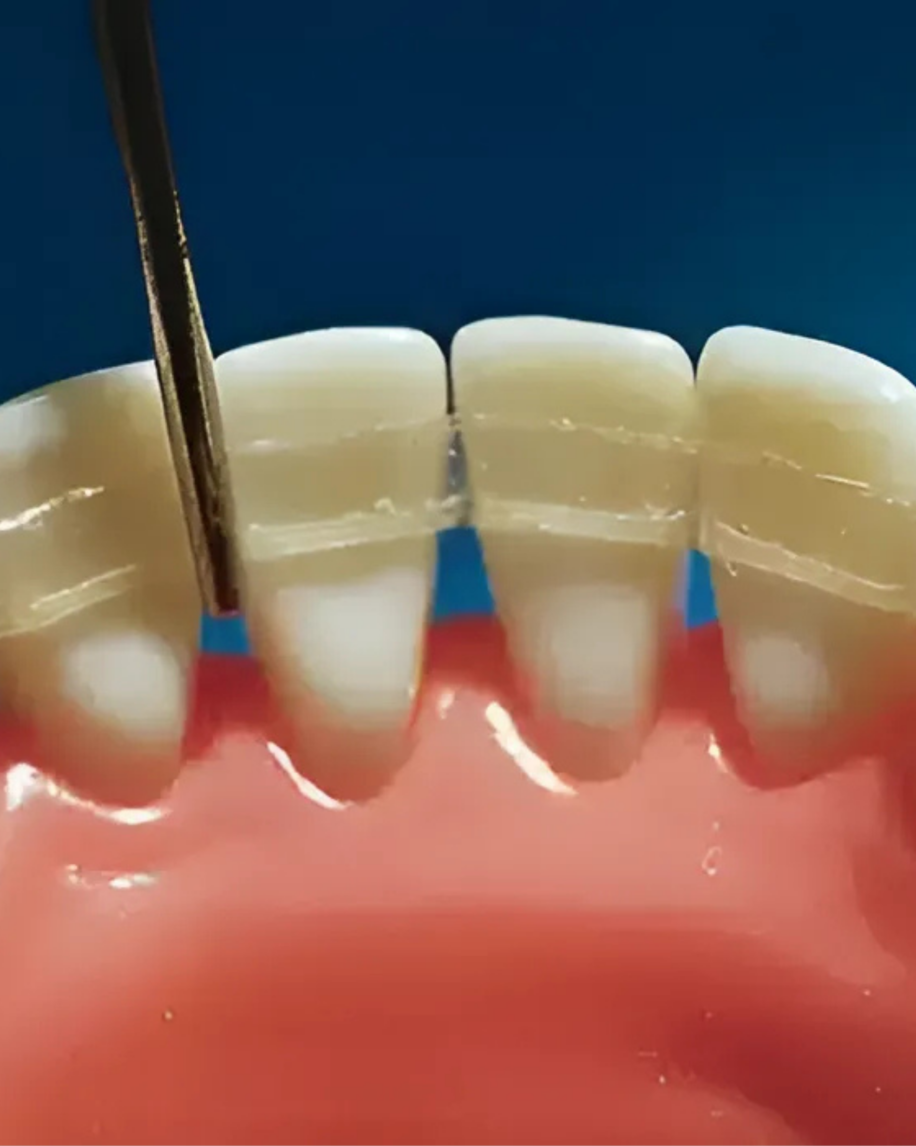 Perio Splint (Fibre-Reinforced Splinting) – K Sud Dental